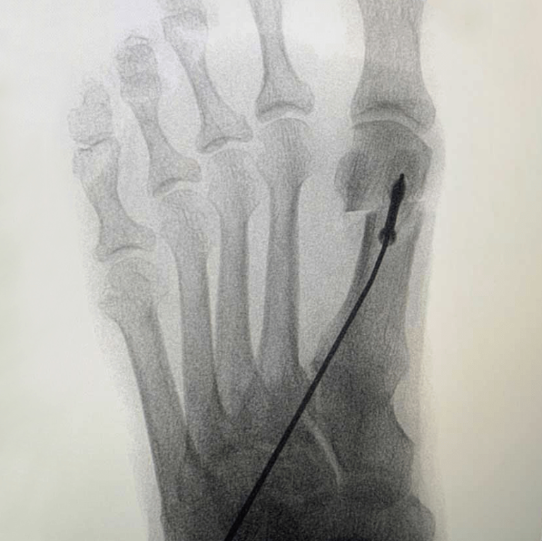 MIS CHEVRON PRECISION BUNION SYSTEM - RELJA Innovations - MIS Precision ...