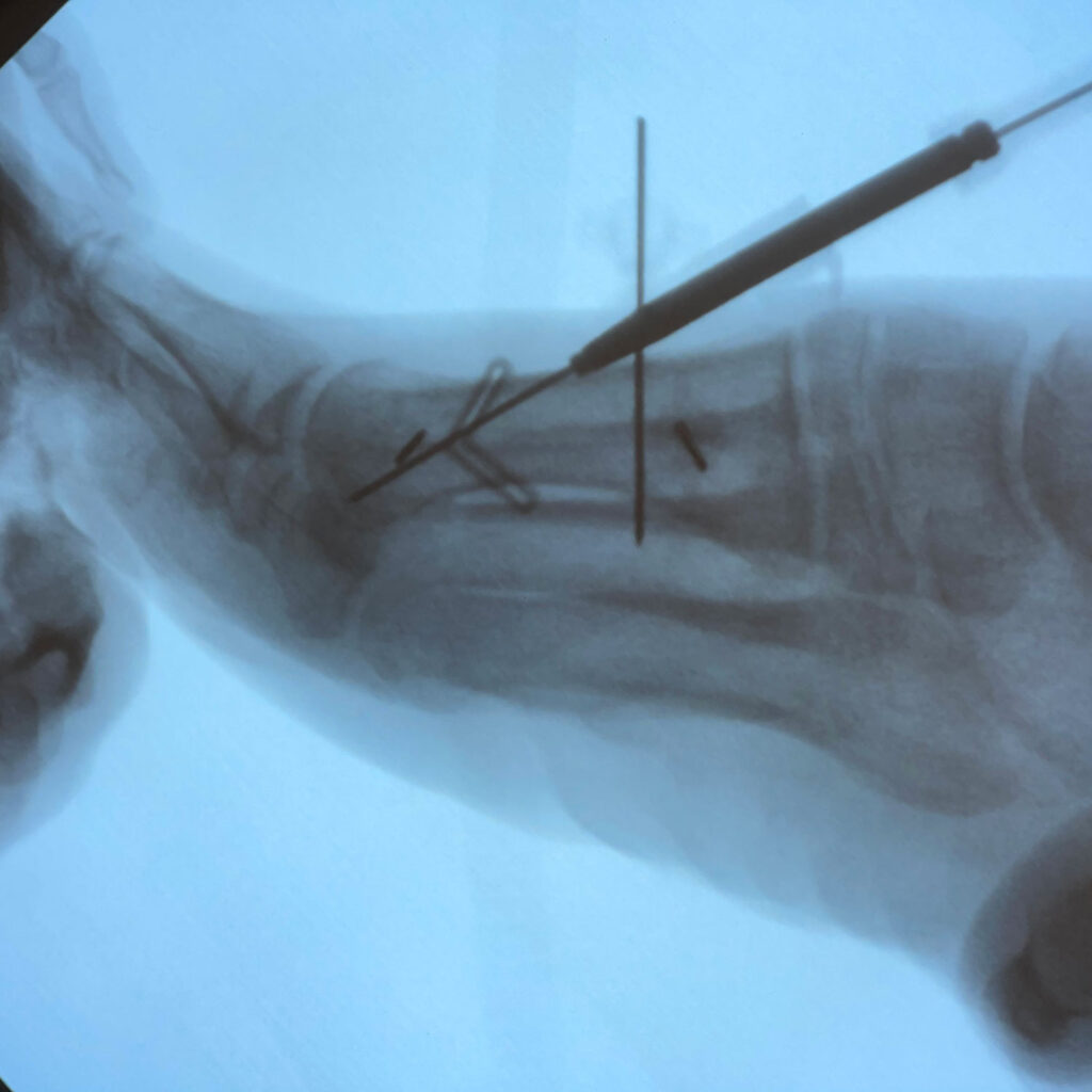 Relja - Precision Chevron Bunion System