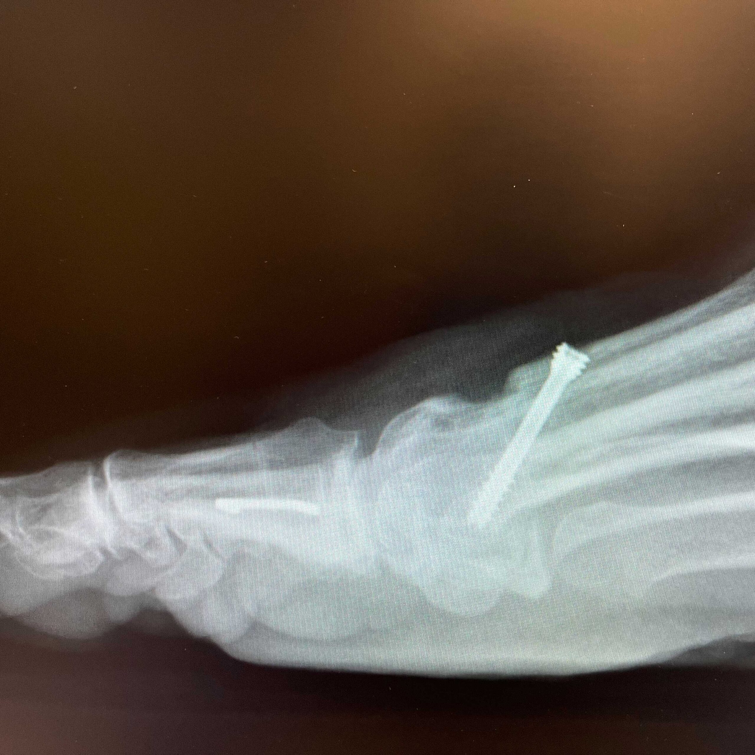 MIS CHEVRON PRECISION BUNION SYSTEM - RELJA Innovations - MIS Precision ...
