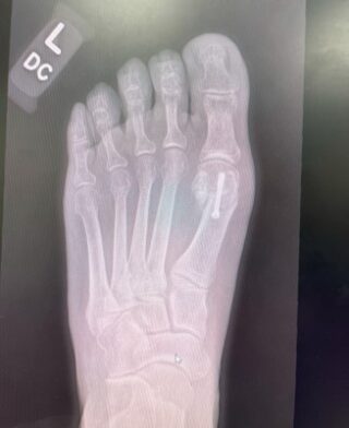 MIS CHEVRON PRECISION BUNION SYSTEM - RELJA Innovations - MIS Precision ...