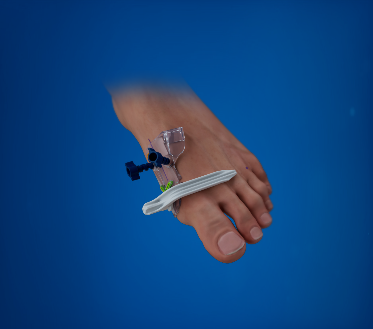 MIS CHEVRON PRECISION BUNION SYSTEM - RELJA Innovations