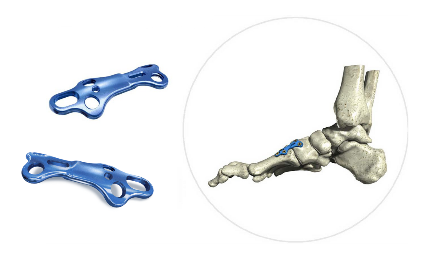 The RELJA Foot Plating System - RELJA Innovations - MIS Precision ...