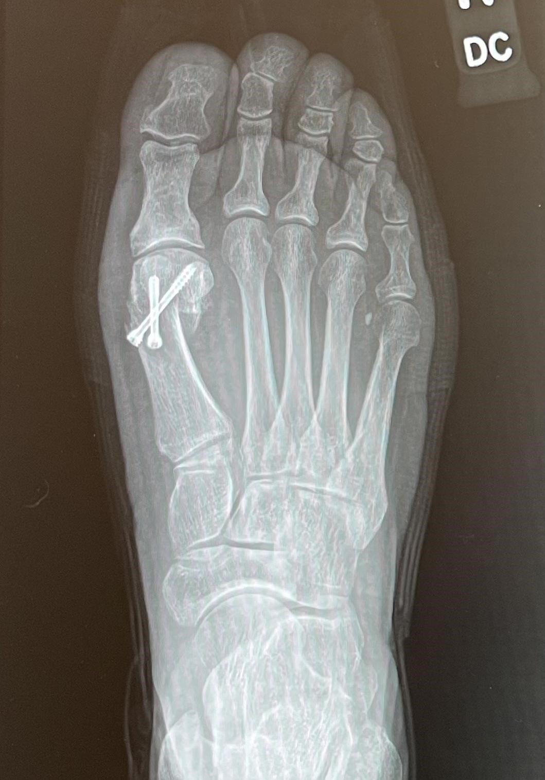 MIS CHEVRON PRECISION BUNION SYSTEM - RELJA Innovations - MIS Precision ...