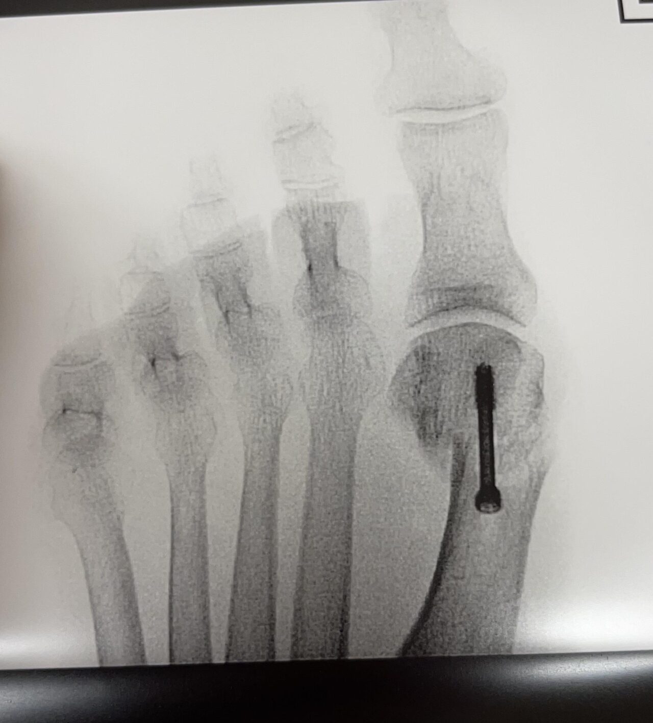 MIS CHEVRON PRECISION BUNION SYSTEM - RELJA Innovations - MIS Precision ...